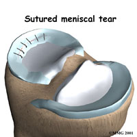 Meniscus Repair Surgery in Kirkland, WA | Robin Fuchs, MD, MBA