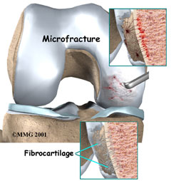 Microfracture Treatment in Kirkland, WA | Robin Fuchs, MD, MBA