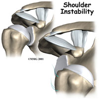 Shoulder Joint Instability | Robin Fuchs, MD, MBA