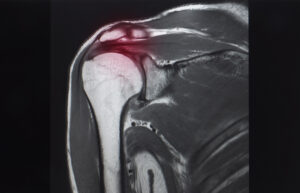 Do Rotator Cuff Tears Heal Themselves? - Robin Fuchs, M.D.
